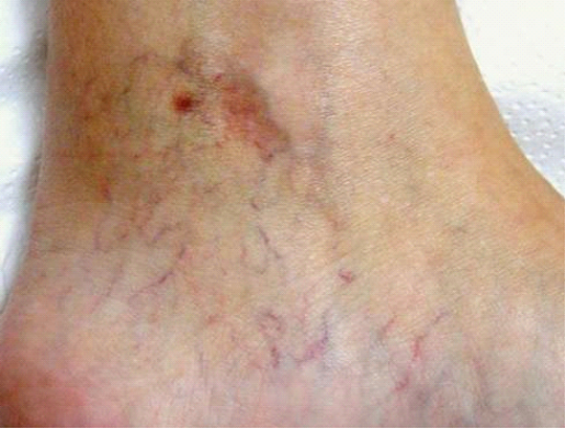 Vascular Lesions – MeRay